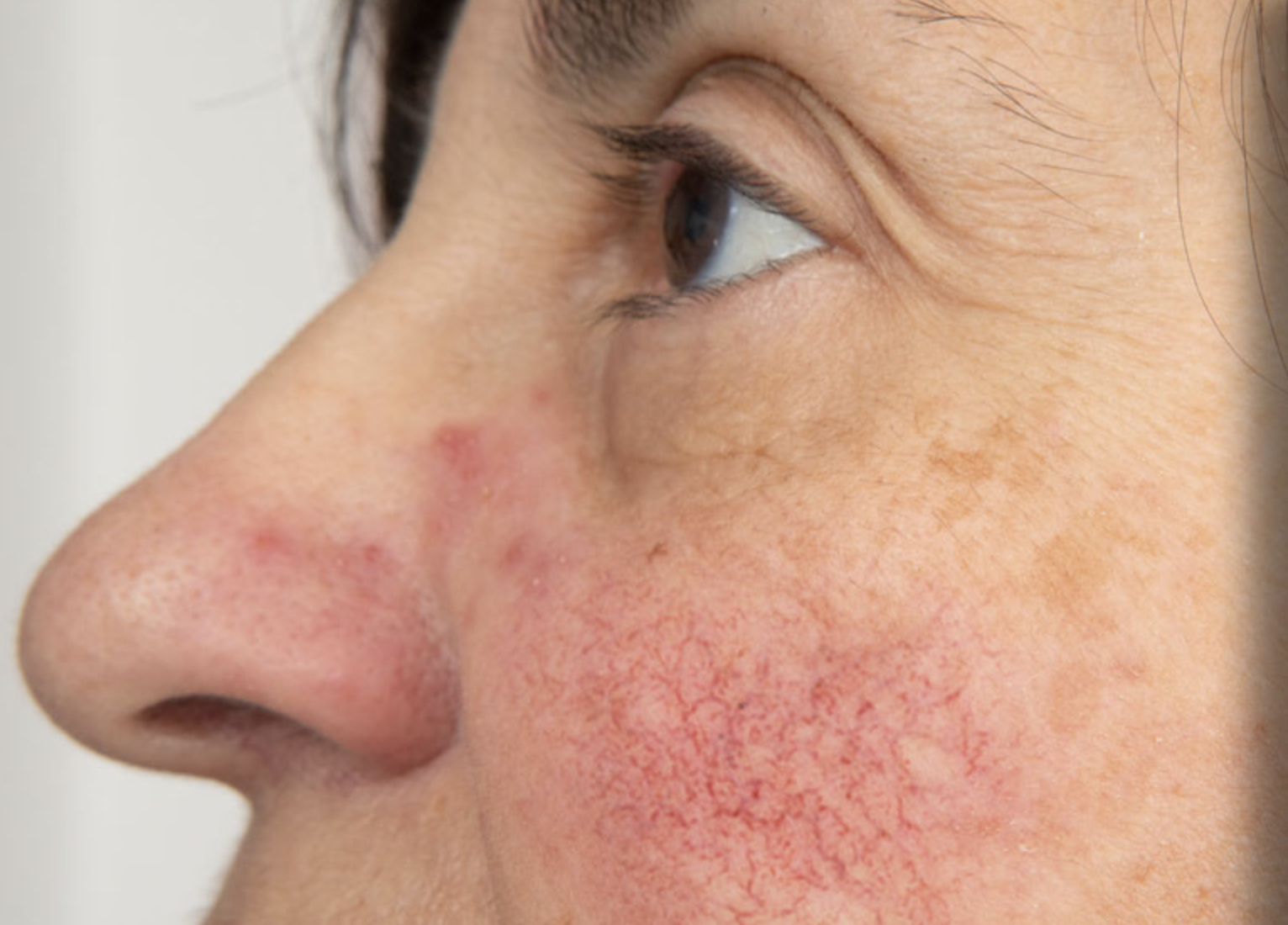 Dermatology Associates | Rosacea