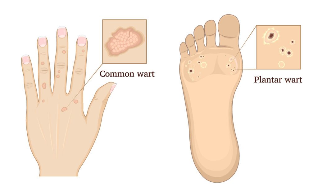 Dermatology Associates | Warts