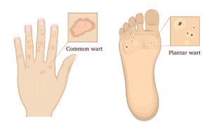 Dermatology Associates | Warts