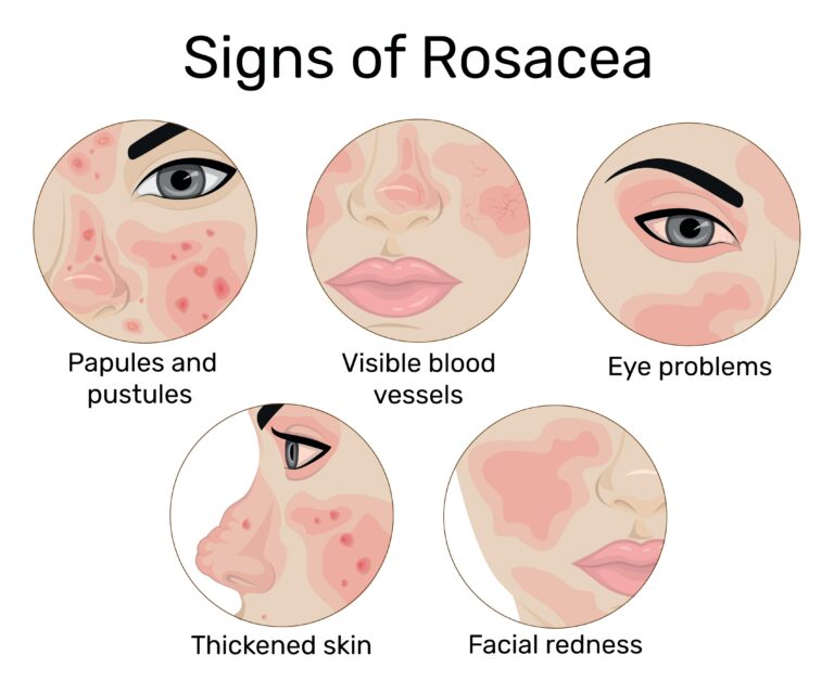 Rosacea Demystified: Insights into Causes, Symptoms, and Treatment ...
